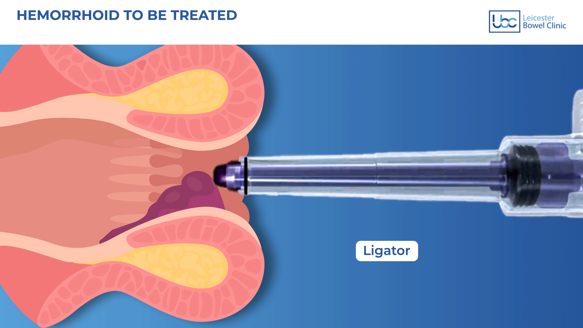 Banding of Haemorrhoids(Piles) - Leicester Bowel Clinic