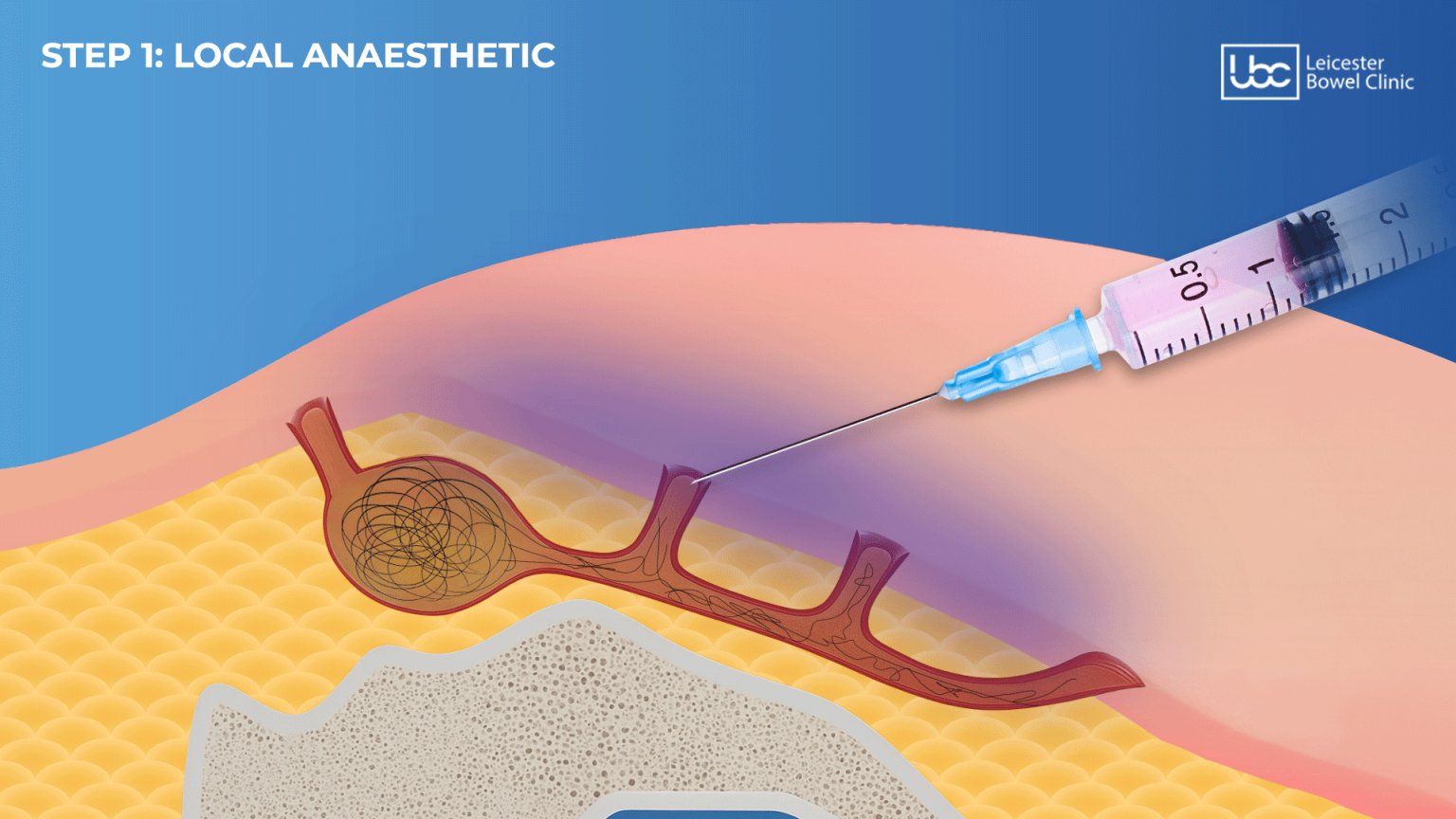 Pilonidal Sinus Laser-Assisted Closure in Leicester