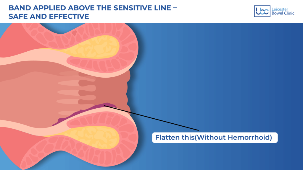 Banding of Haemorrhoids(Piles) - Leicester Bowel Clinic