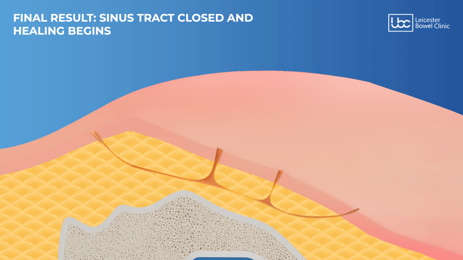 Pilonidal Sinus Laser-Assisted Closure in Leicester
