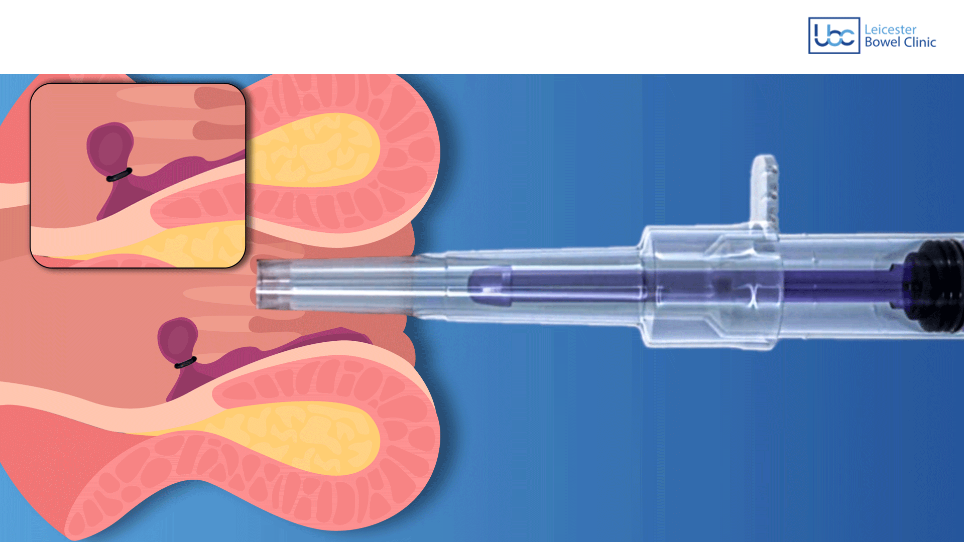 Banding of Haemorrhoids(Piles) - Leicester Bowel Clinic