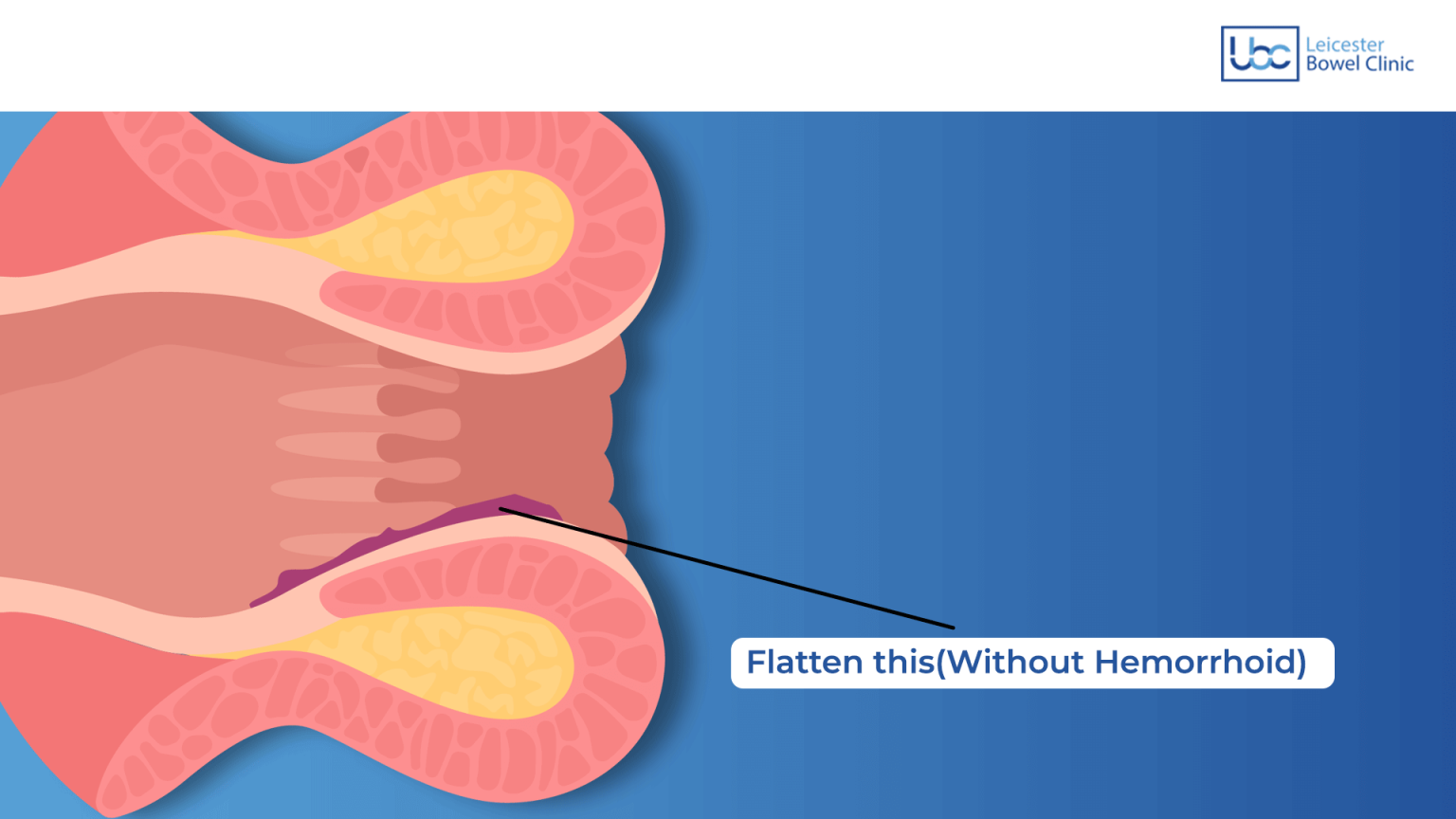Banding of Haemorrhoids(Piles) - Leicester Bowel Clinic