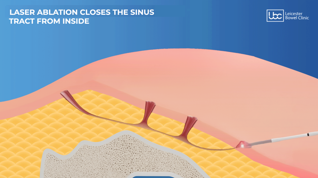 Pilonidal Sinus Treatment Without Surgery: Complete Guide
