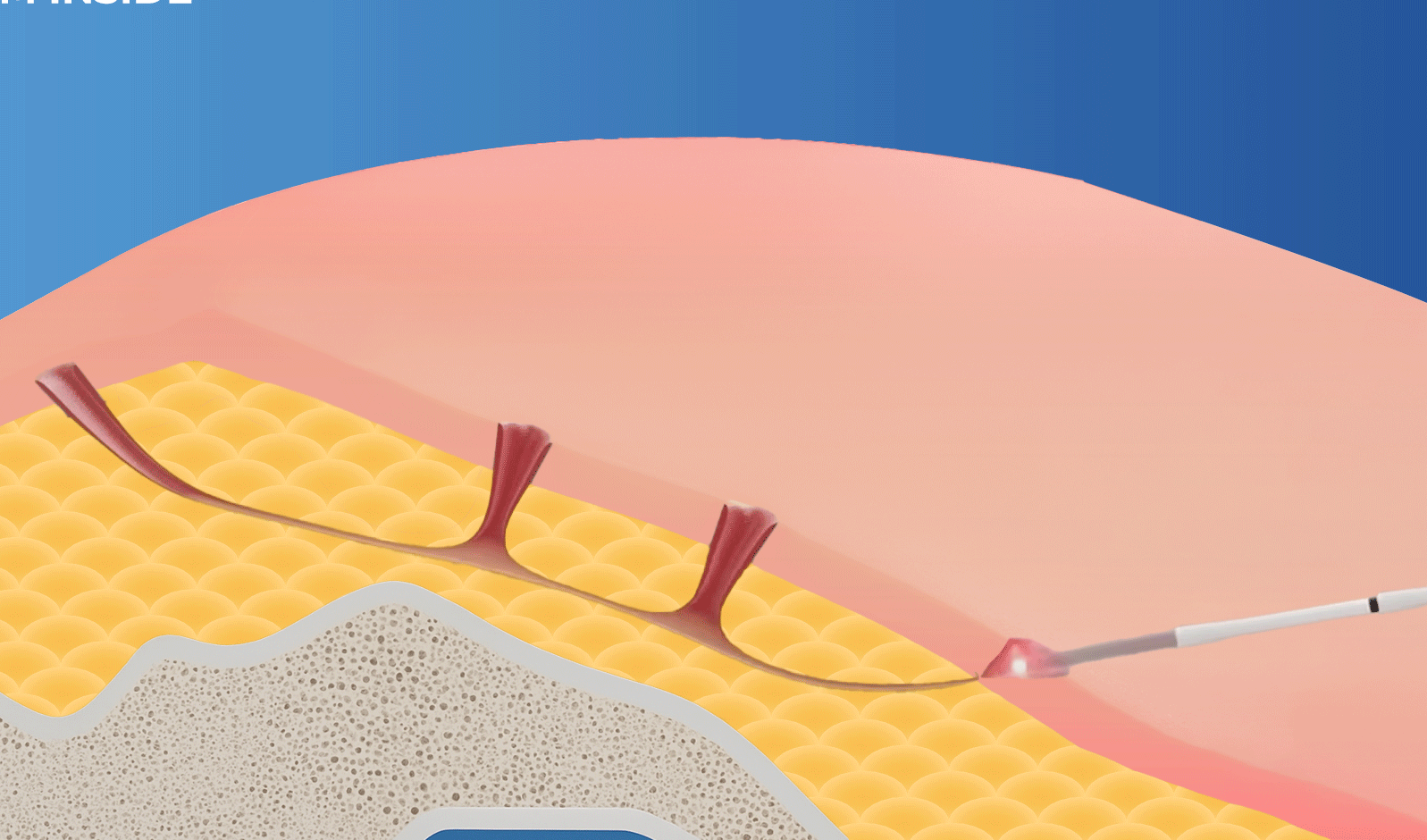 Pilonidal Sinus Treatment Without Surgery: Complete Guide
